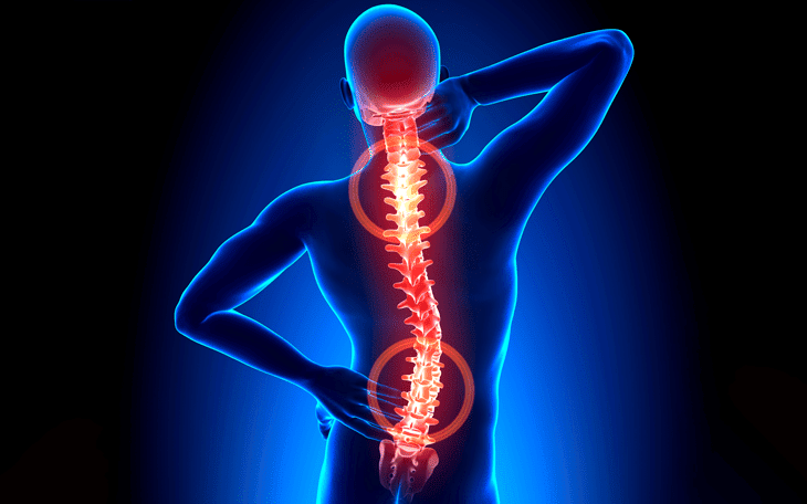 Incapacidad por Artrosis de Columna. Todo lo que debe saber